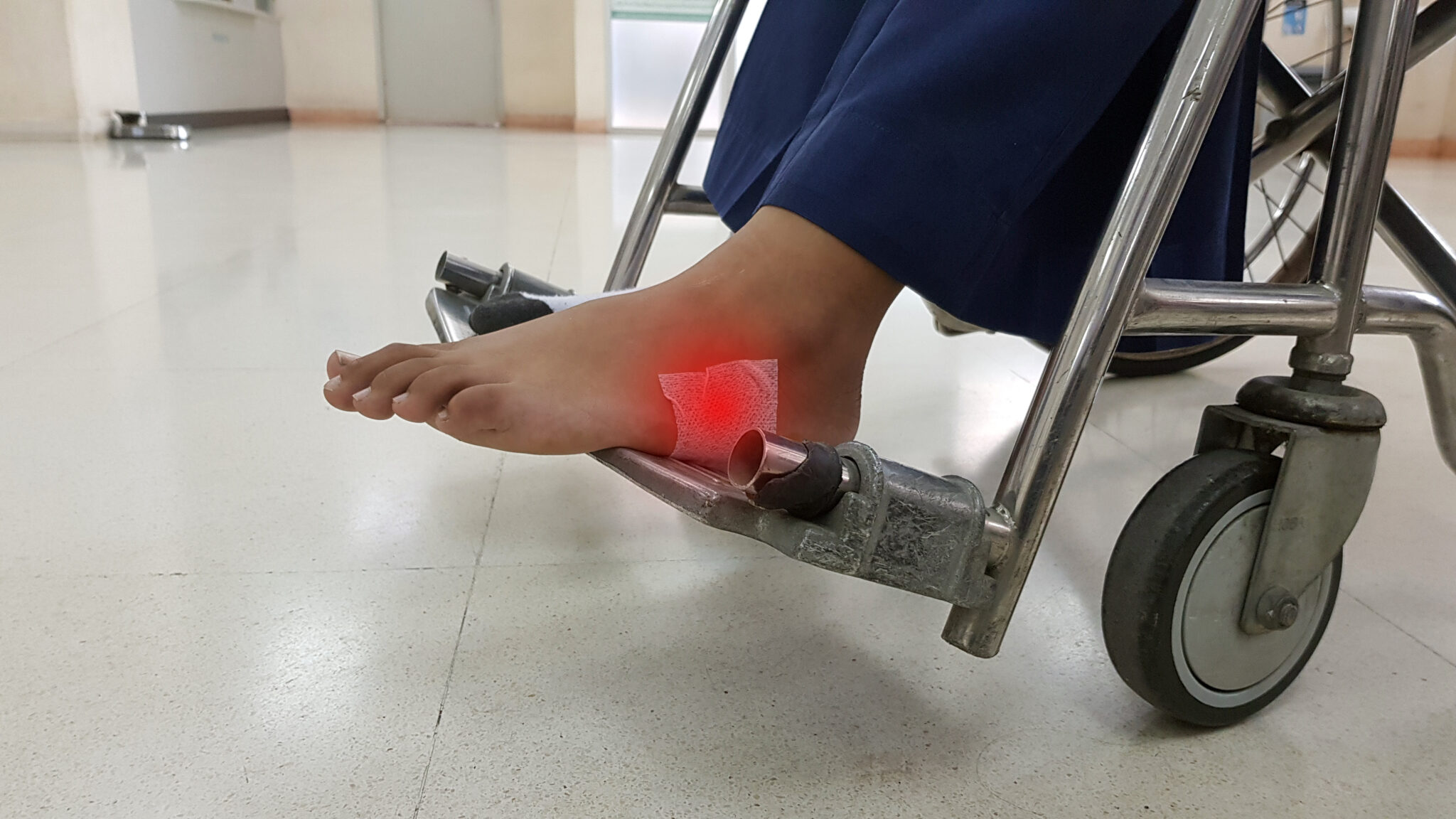 Diabetic Wounds - Podiatry of Greater Cleveland
