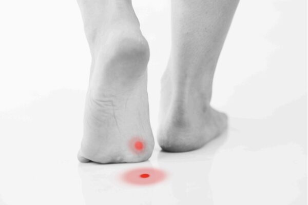 Plantar Warts: Why They Happen and How to Get Rid of Them for Good ...